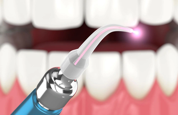 Laser Bacterial Reduction Long Beach CA - Long Beach Dental Health